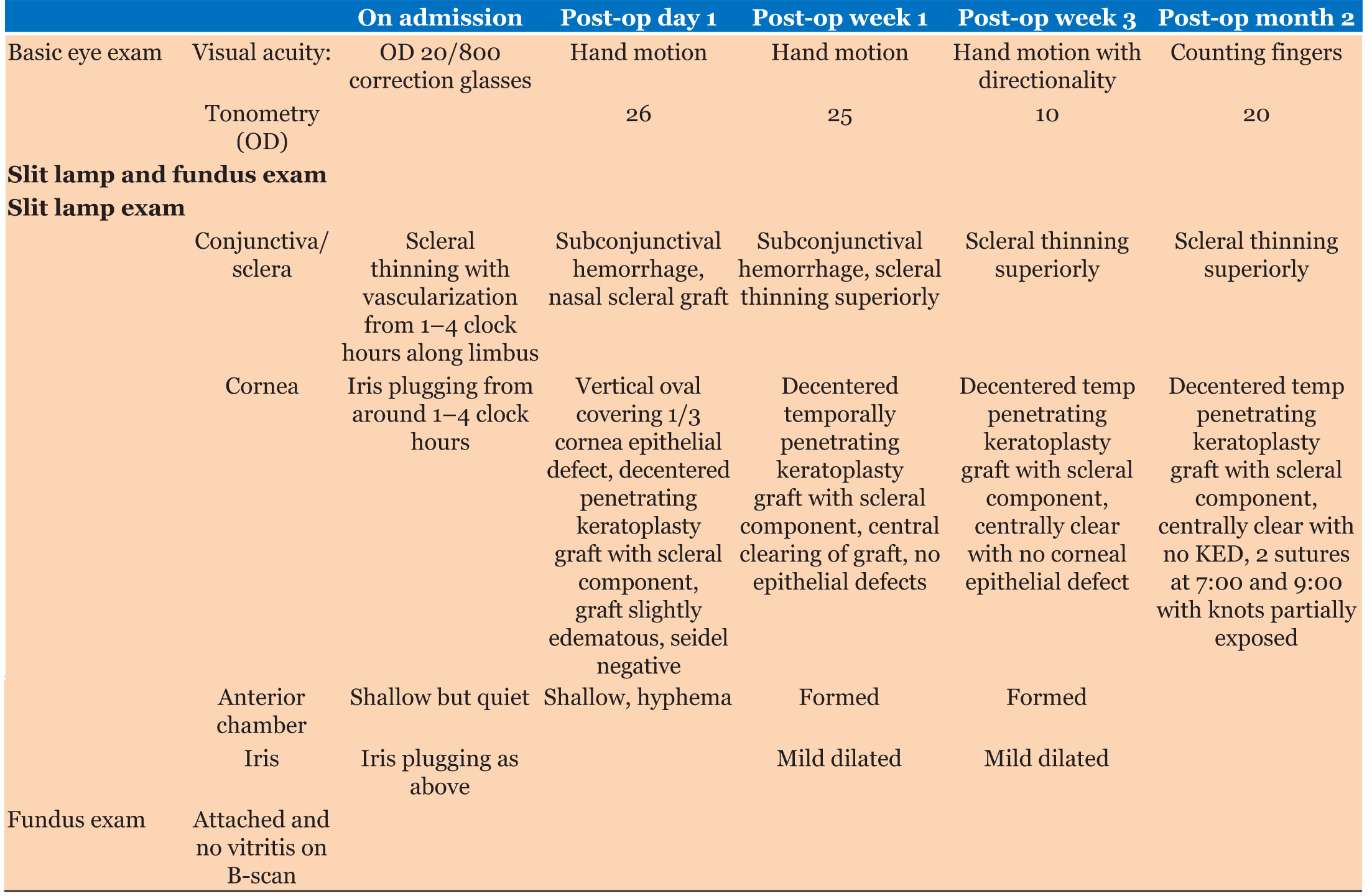 Corneal melt in a patient with rheumatoid arthritis on methotrexate and ...